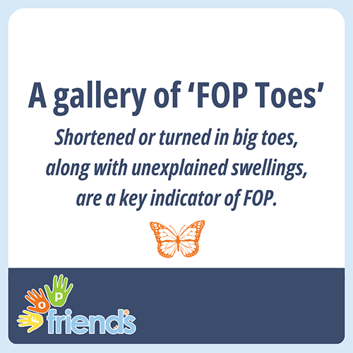 Diagnosing FOP - FOP Friends